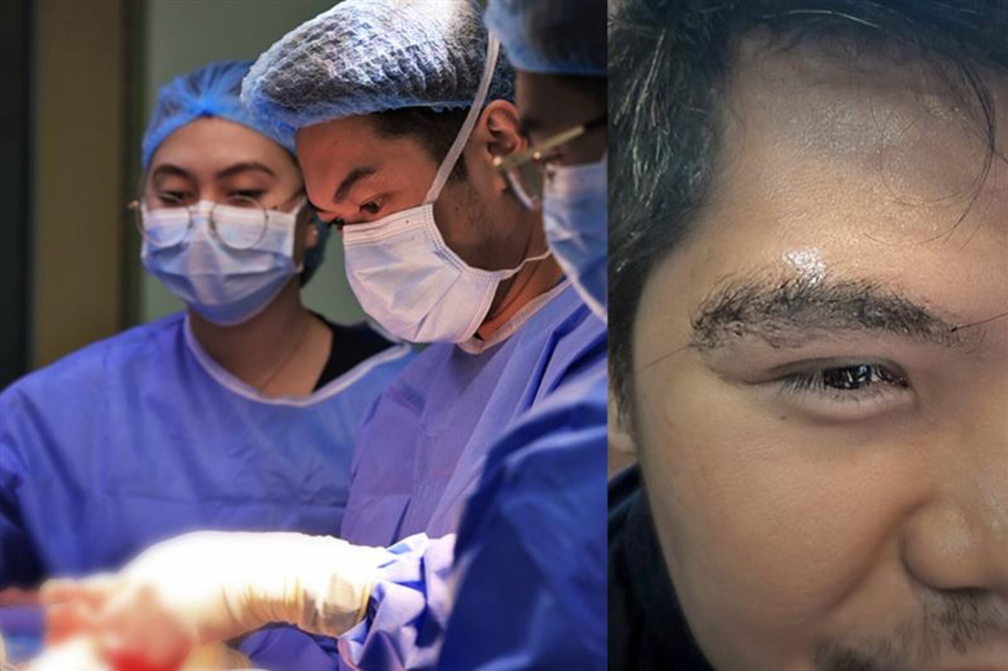 Patient’s vision restored, brain tumor removed through eyebrow surgery ...